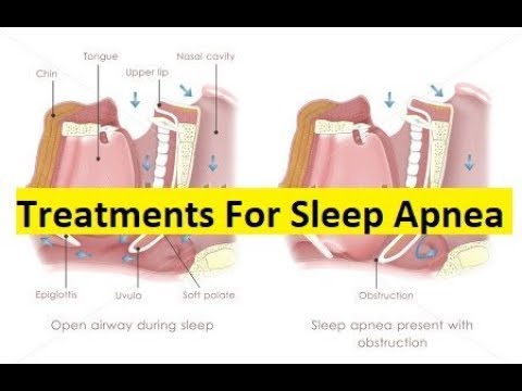 Treatments For Sleep Apnea - How To Cure Sleep Apnea - YouTube