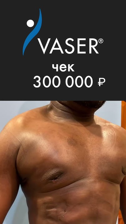 VASER: Эффективное решение гинекомастии у мужчин - YouTube
