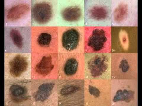 Ear cancer pictures - YouTube