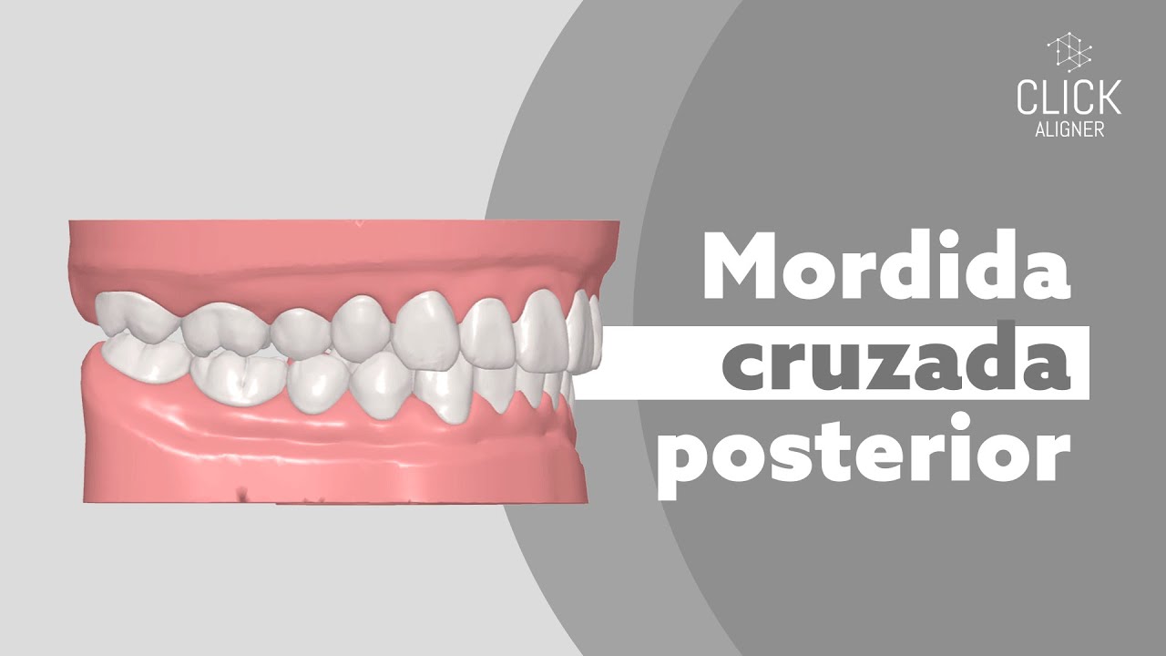 Click Talk's - Mordida Cruzada Posterior, com Dr. Rafael Morawski e Dra ...