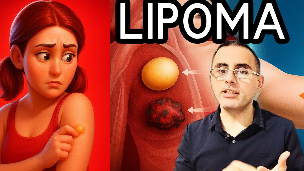 Lipoma Explained in 6 Minutes - Soft, Benign, and More Common Than You ...