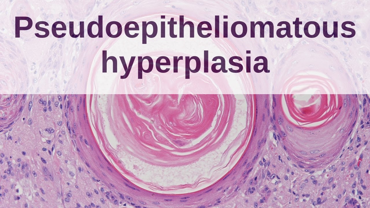 Pseudoepitheliomatous Hyperplasia Pathology Mini Tutorial YouTube pseudoepitheliomatous-hyperplasia-pathology-mini-tutorial-youtube