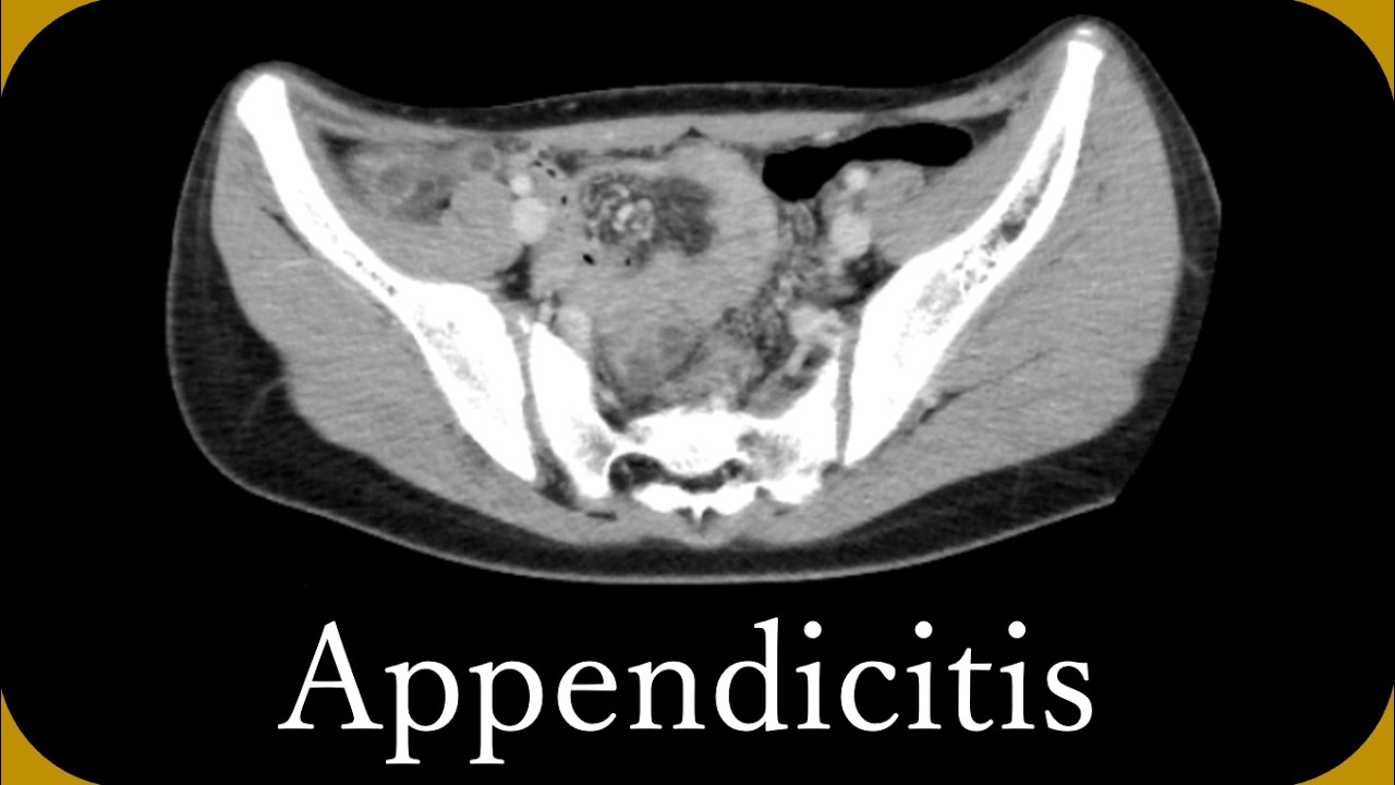 Imaging diagnosis of "Appendicitis" (CT/MRI) trial - YouTube