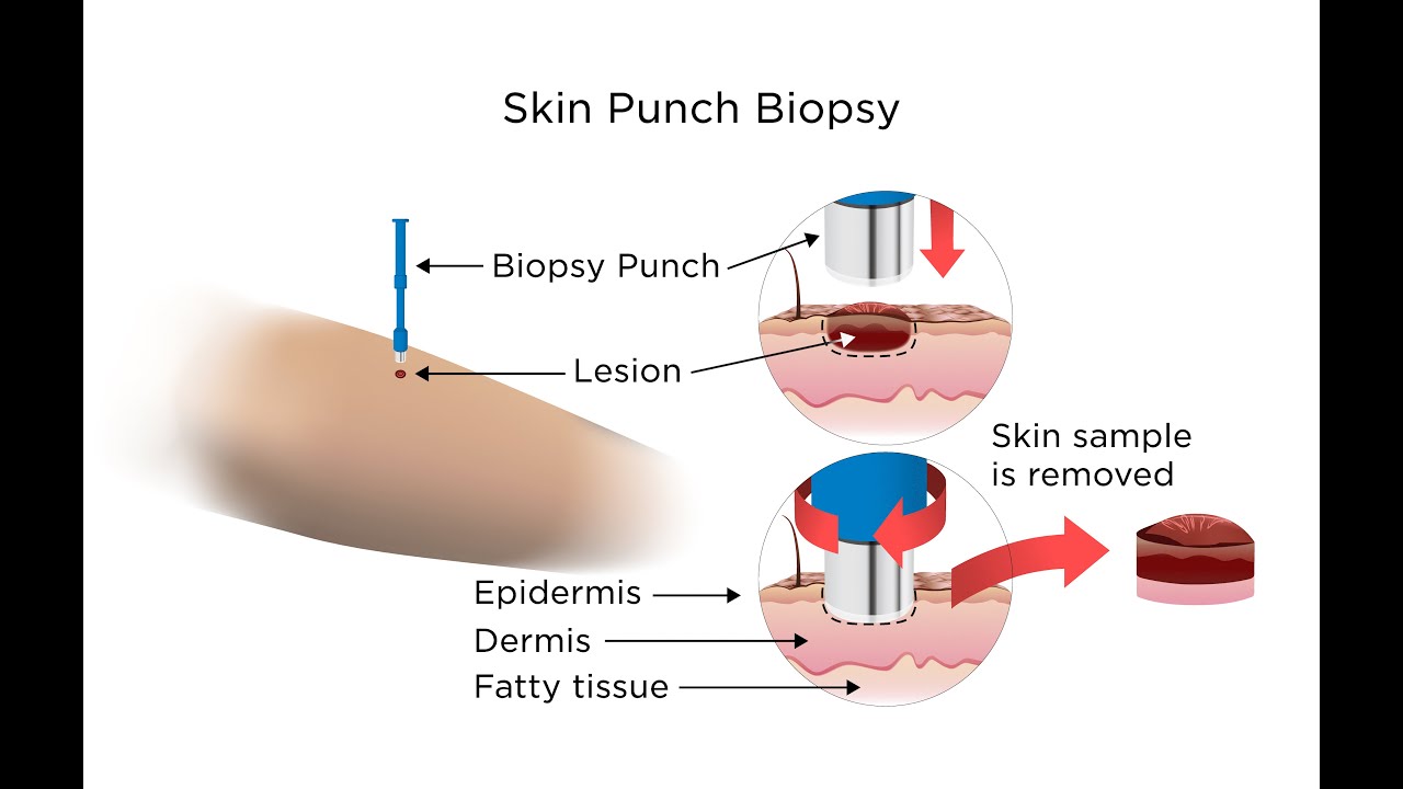 Skin Biopsy Medical Procedure (Shave biopsy, Punch biopsy, Excisional ...