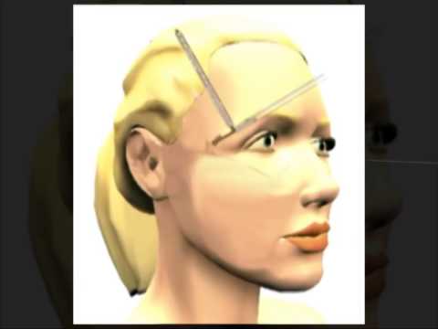 Thread Eyebrow Lift - YouTube
