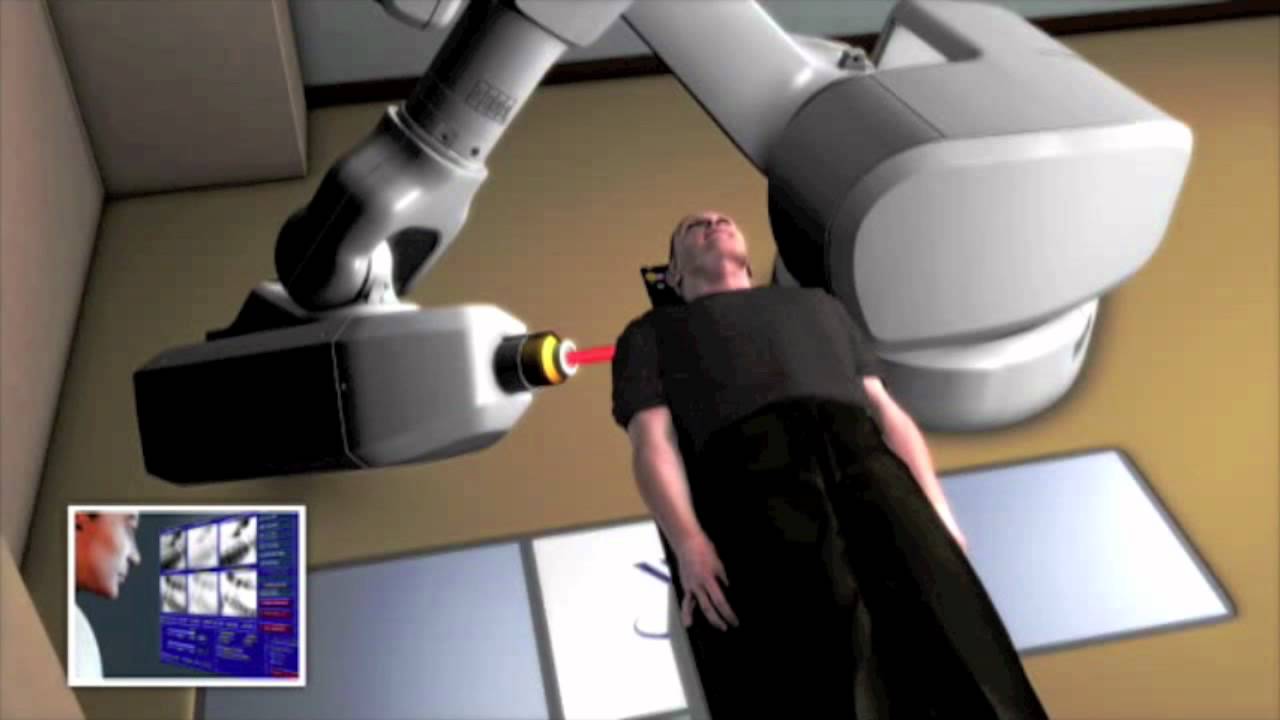 CyberKnife Treatment Option - YouTube