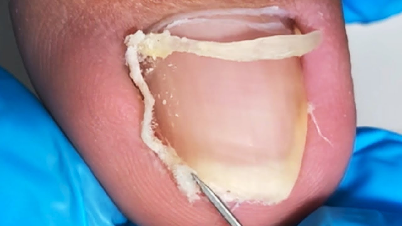 A Circle Of Cotton Was Stuffed Under The Ingrown Nail, And The Nail Was ...