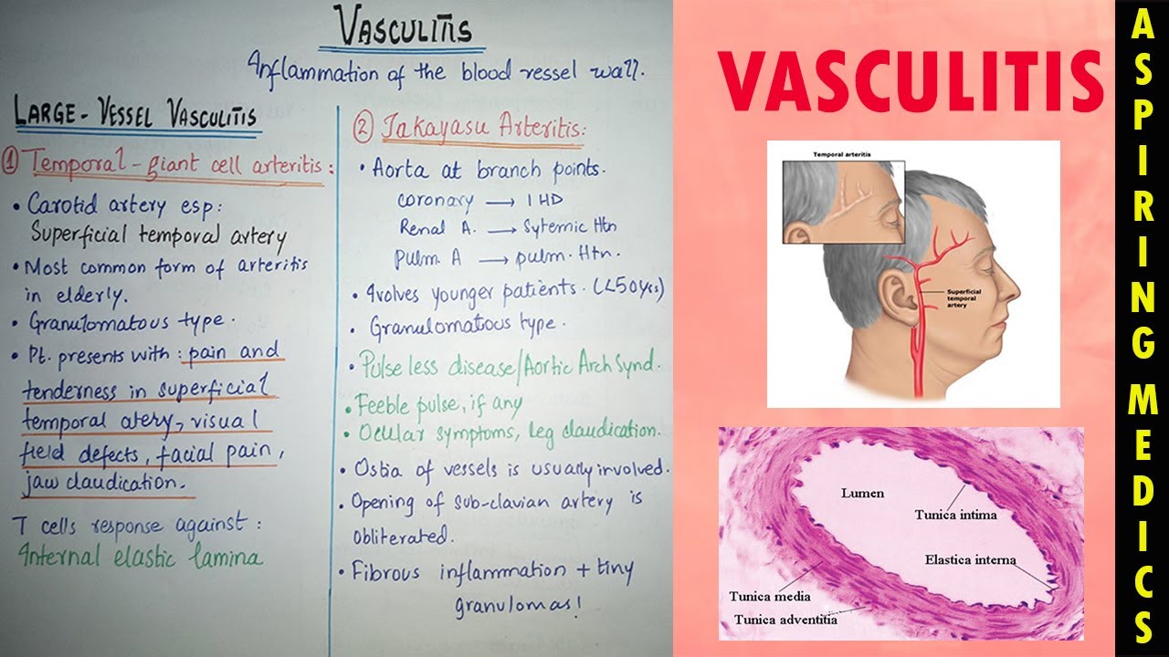 Vasculitis pathology lecture part 1-Temporal giant cell and takayasu's ...