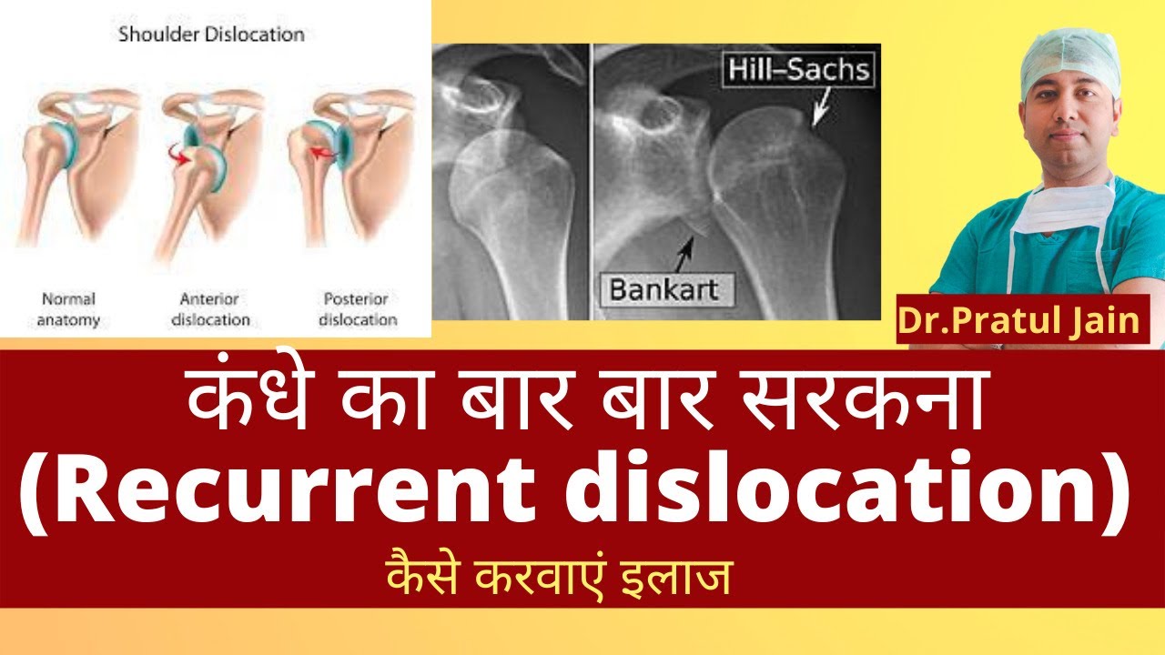 कंधे का बार-बार सरकना | Recurrent Shoulder Dislocation: Best Treatment ...