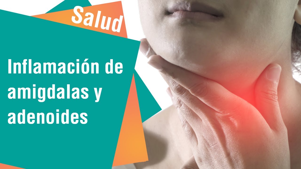 Inflamación de amigdalas y adenoides: Causas y tratamiento | Salud ...