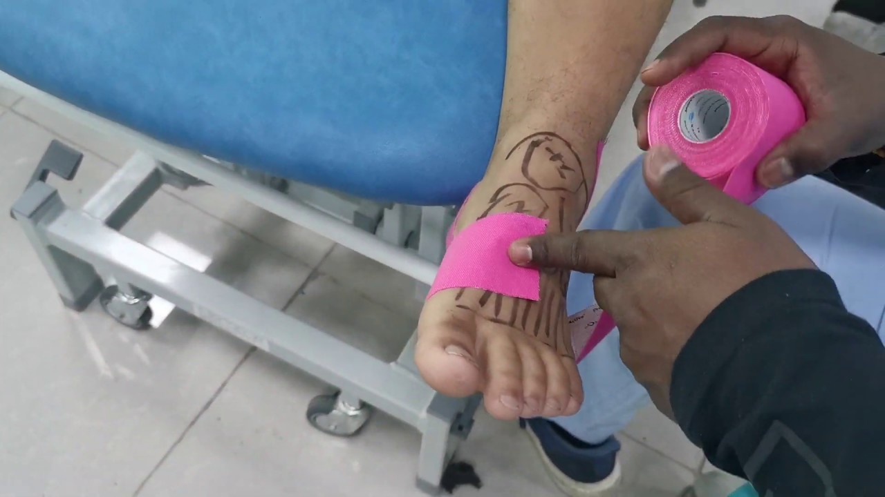 Club foot treatment for Pediatric - YouTube