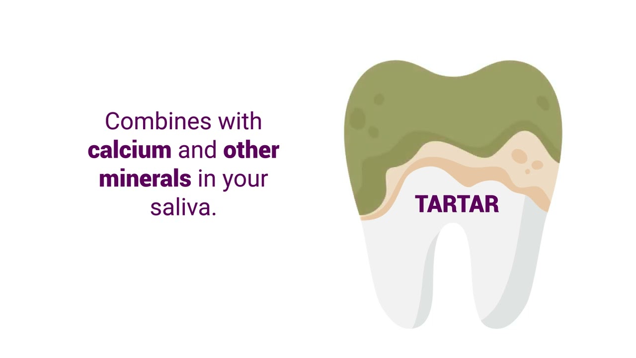 Plaque vs Tartar - YouTube