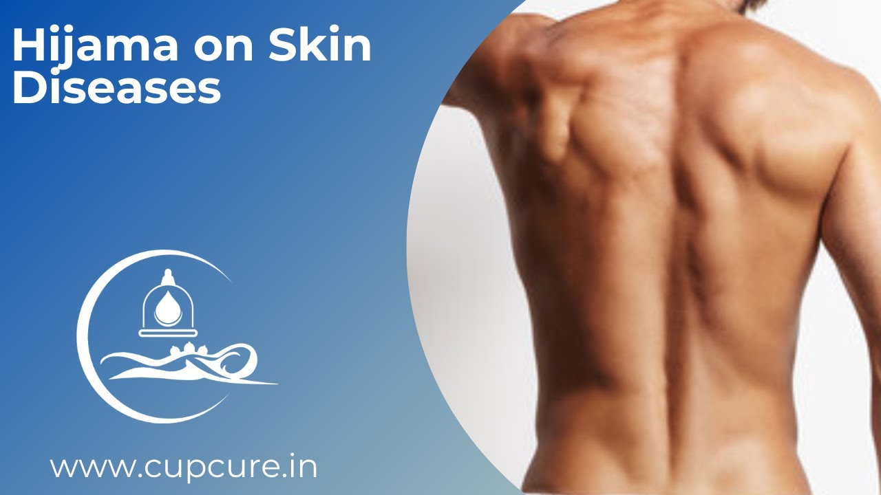 FAQ#11 | How to do Hijama for Skin Disease - YouTube