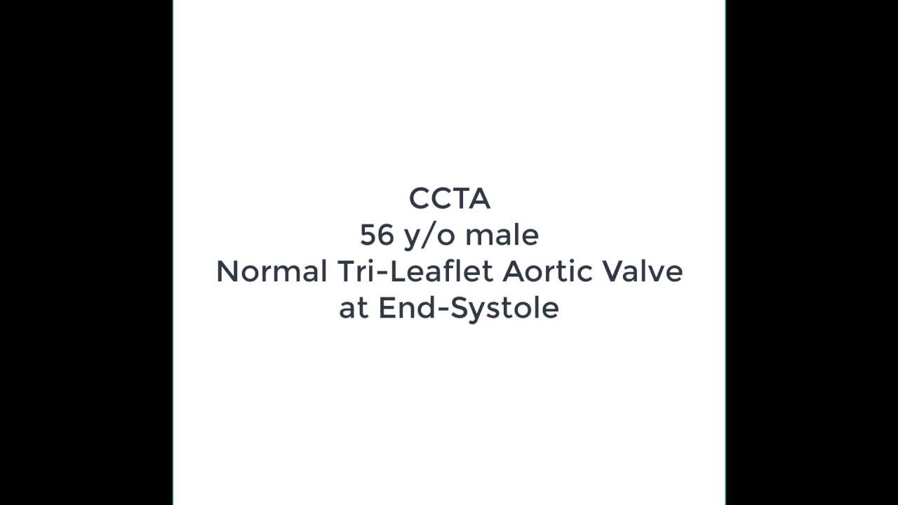 ccta normal aortic valve - YouTube
