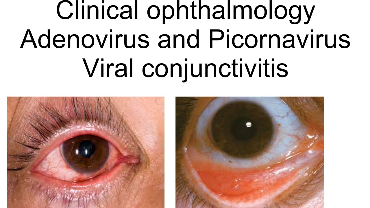 Clinical ophthalmology VIRAL CONJUNCTIVITIS in easiest way - YouTube