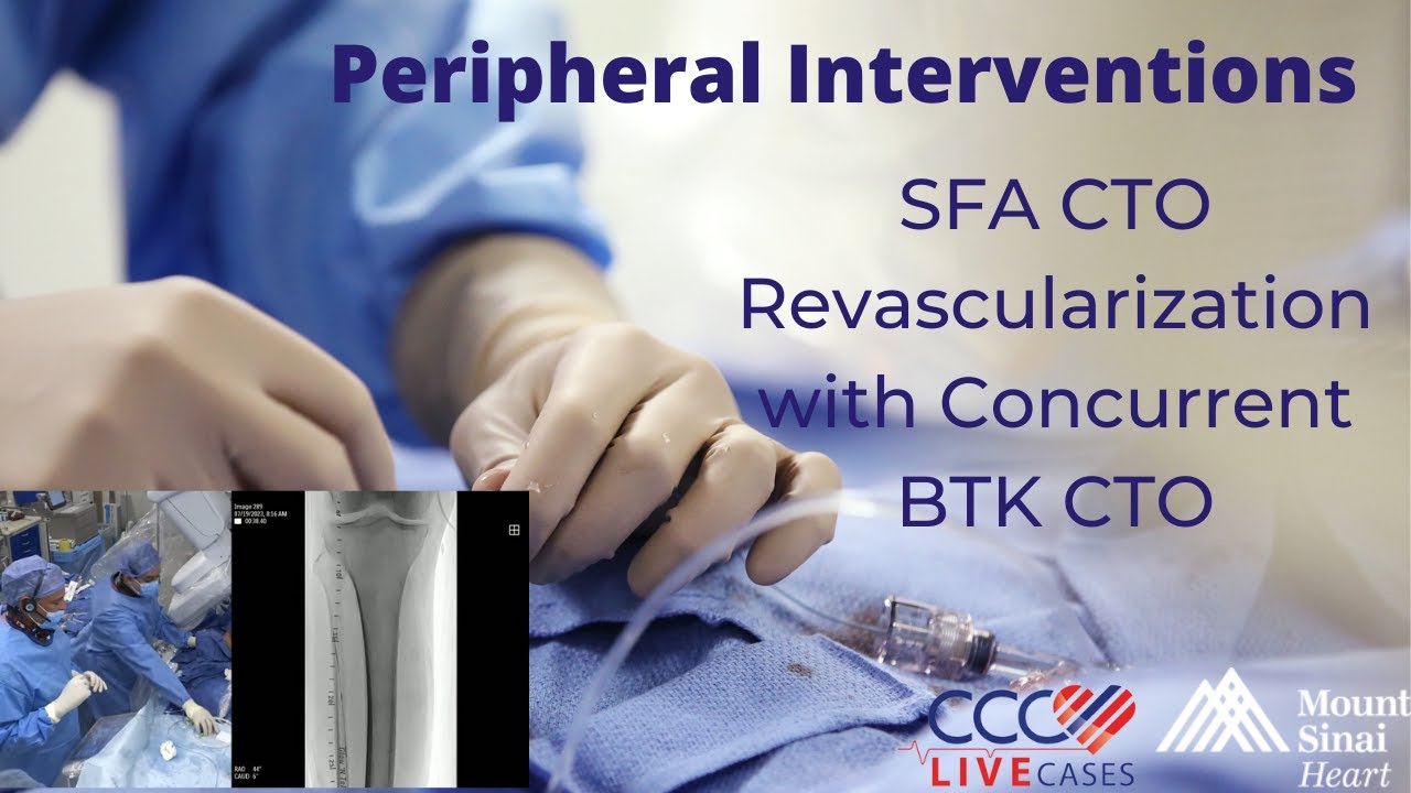 SFA CTO Revascularization with Concurrent BTK CTO - YouTube