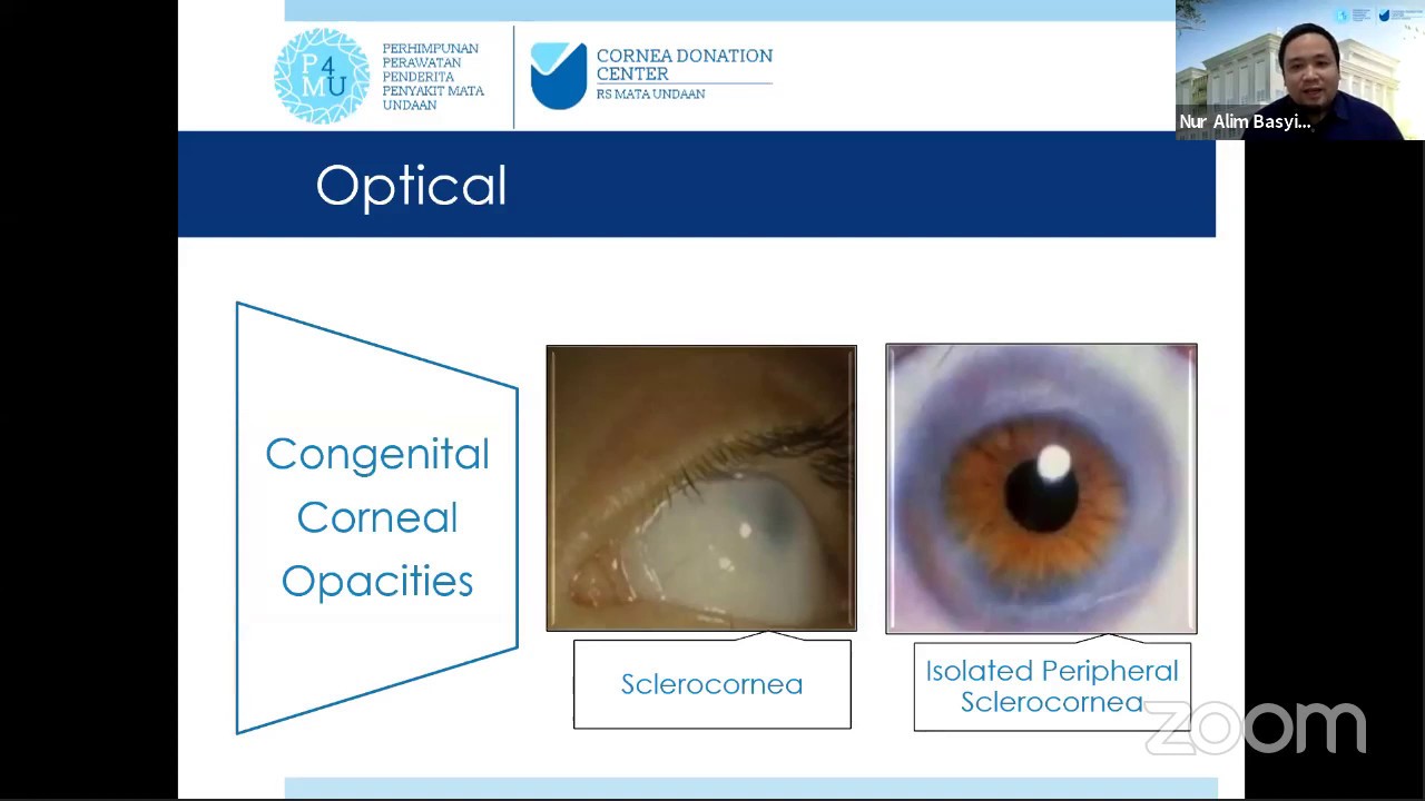 Webinar Cornea Donation Center RS Mata Undaan Sesi 2 | 19 Mei 2020 ...