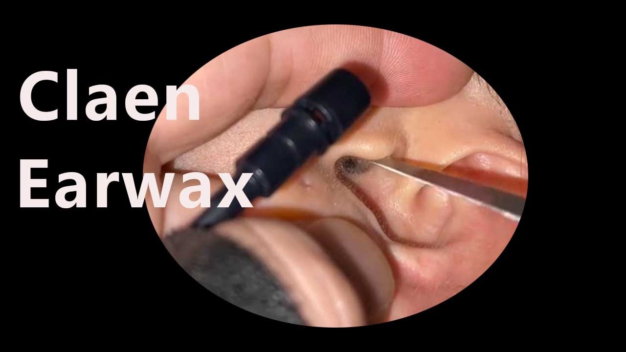 Ear picking tutorial: dealing with foreign objects in the ear and ...