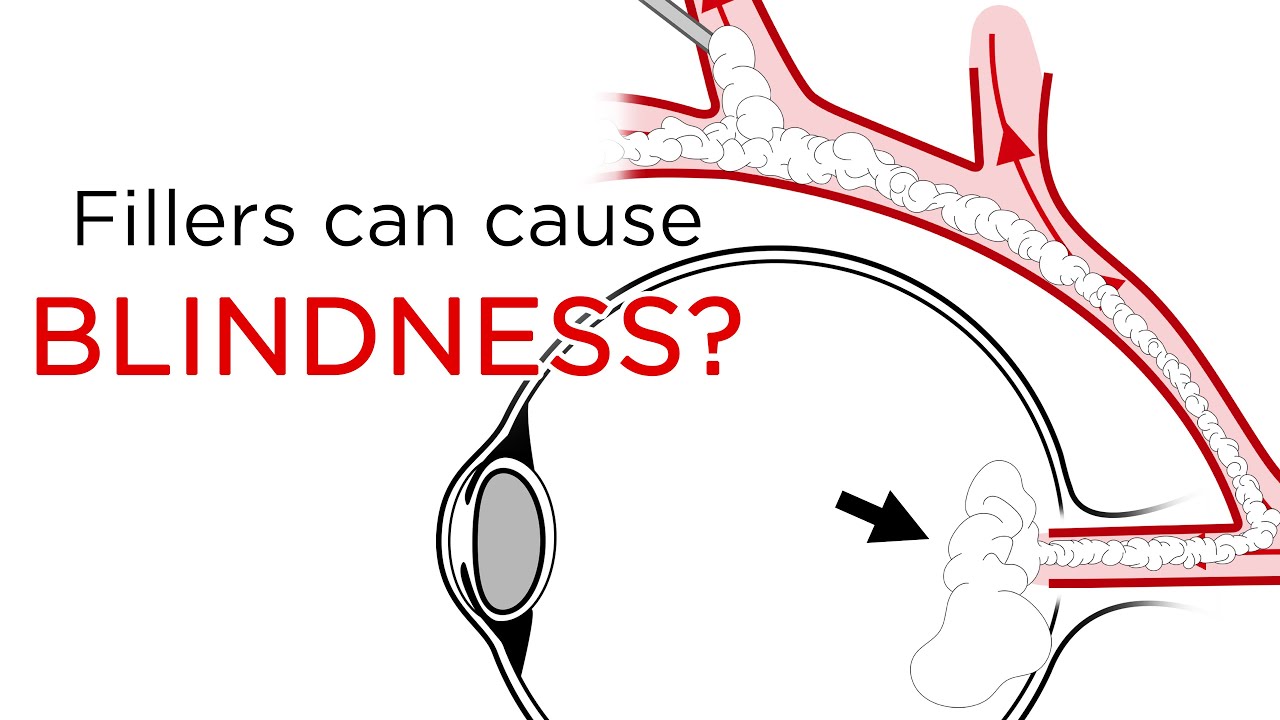 FILLERS CAN CAUSE BLINDNESS | Rare Complication | KNOW YOUR INJECTOR ...