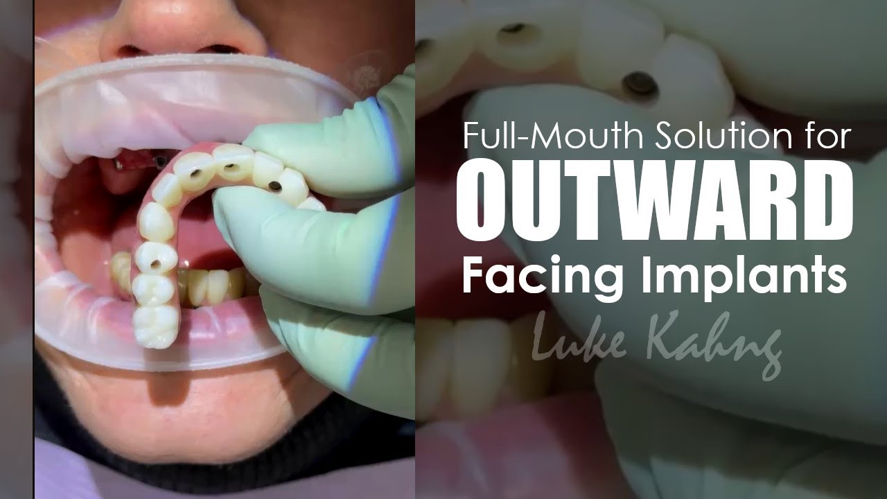 Full-Mouth Solution for Outward-Facing Anterior Implants - YouTube