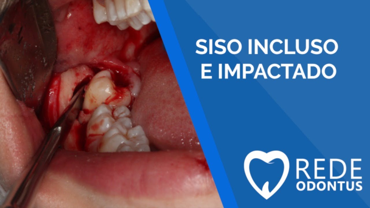 Sisos inclusos e impactados - Caso Clínico - YouTube