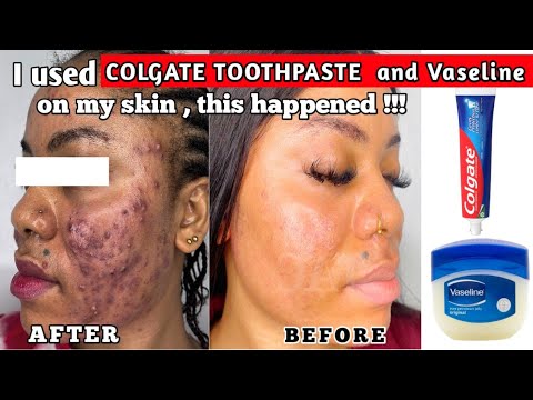I USED VASELINE and COLGATE TOOTHPASTE on my face for whitening ...