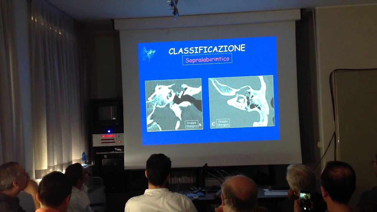 Dr. Anna Lisa Giannuzzi, Colesteatoma della rocca: classificazione ...