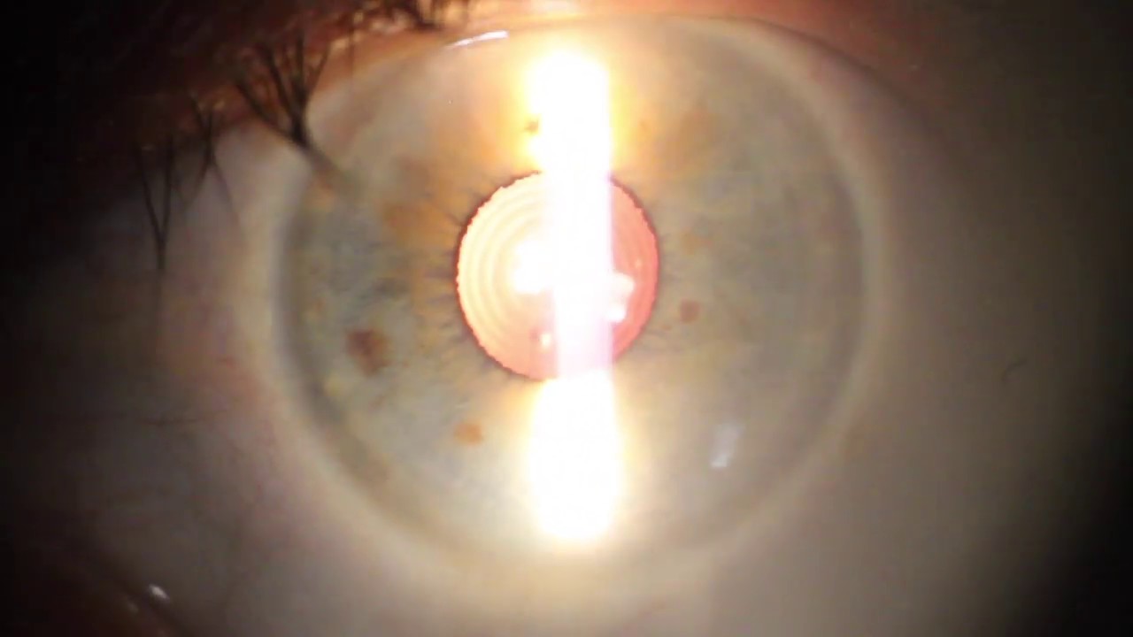 Vista del lente Rayone Trifocal (Rayner, UK, England) en lámpara de ...