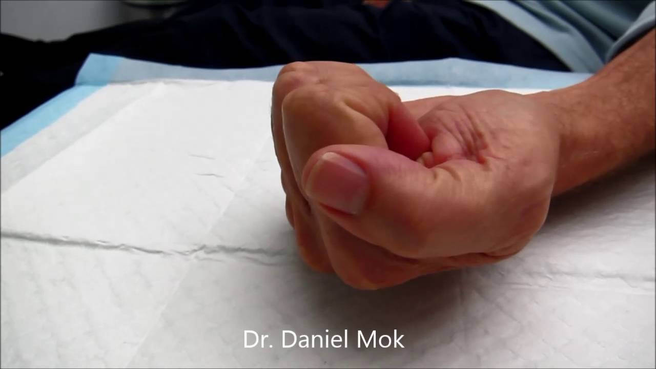 Dupuytren's Contracture - Lt Little & Middle finger - YouTube