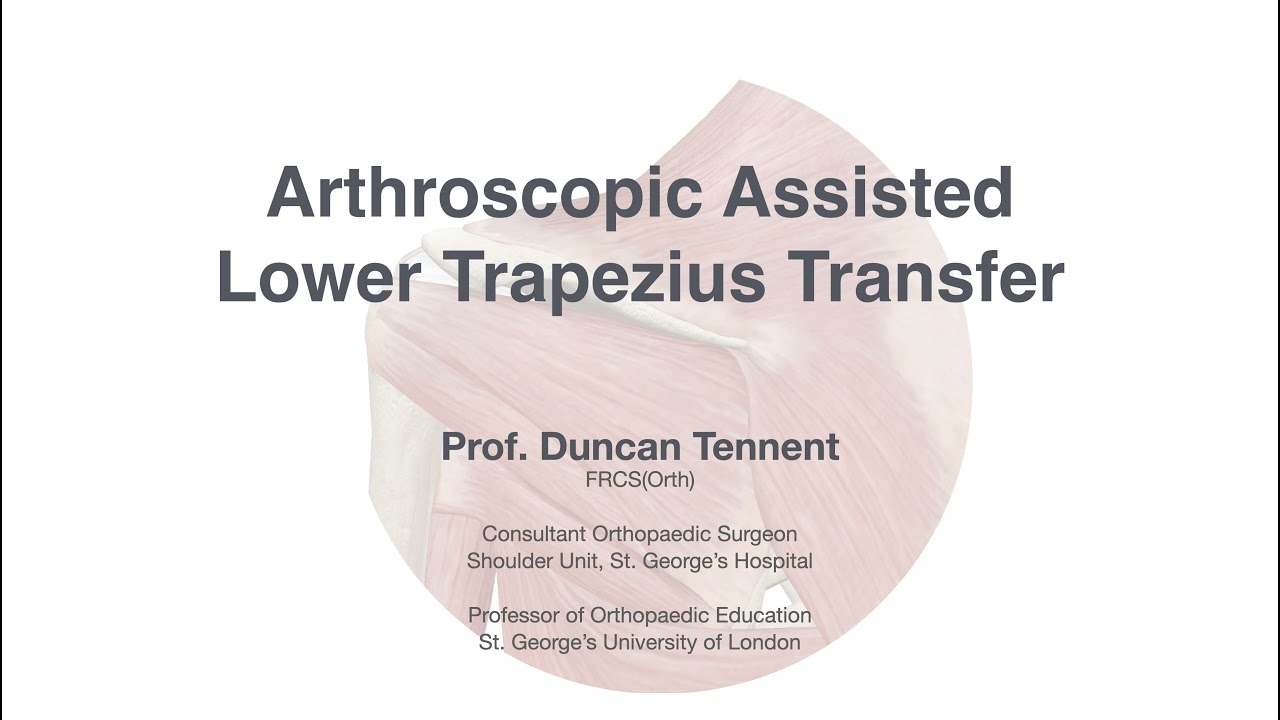 Lower trapezius transfer for massive cuff tear - YouTube