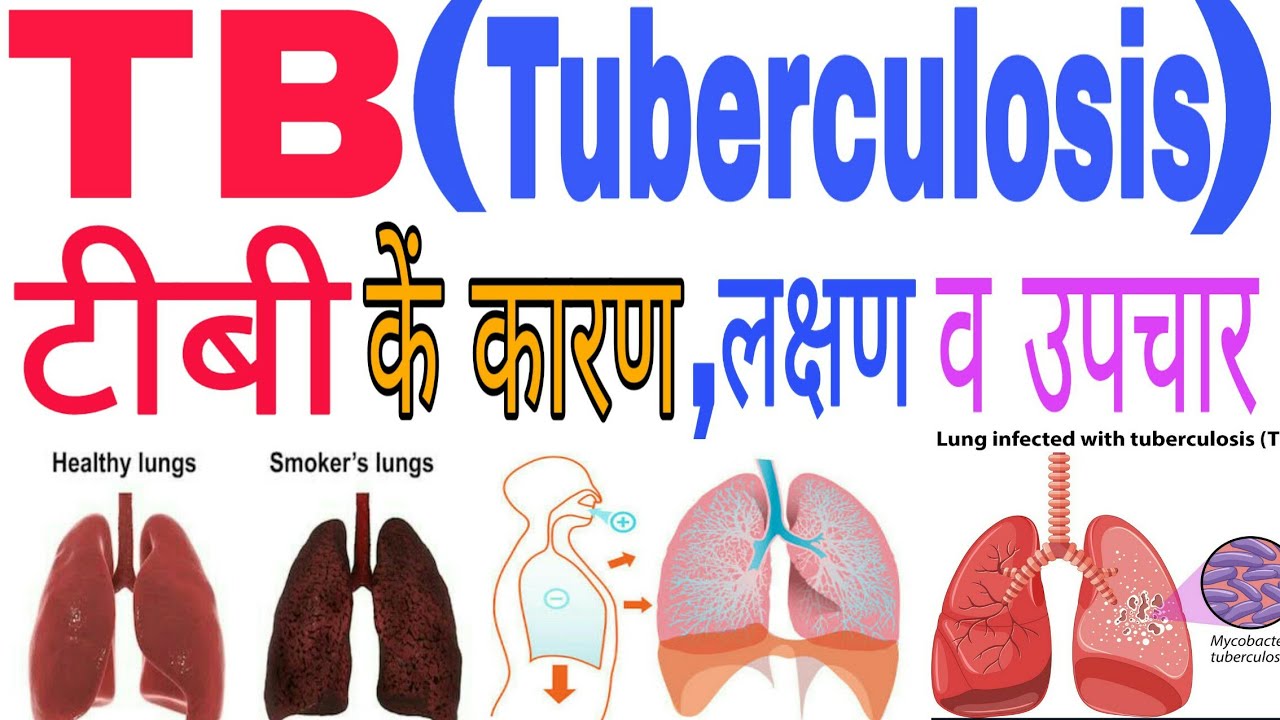 TB disease In Hindi || टीबी के कारण,लक्षण व,उपचार || - Knowledge Tv ...