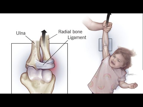 pulled elbow reduction... - YouTube