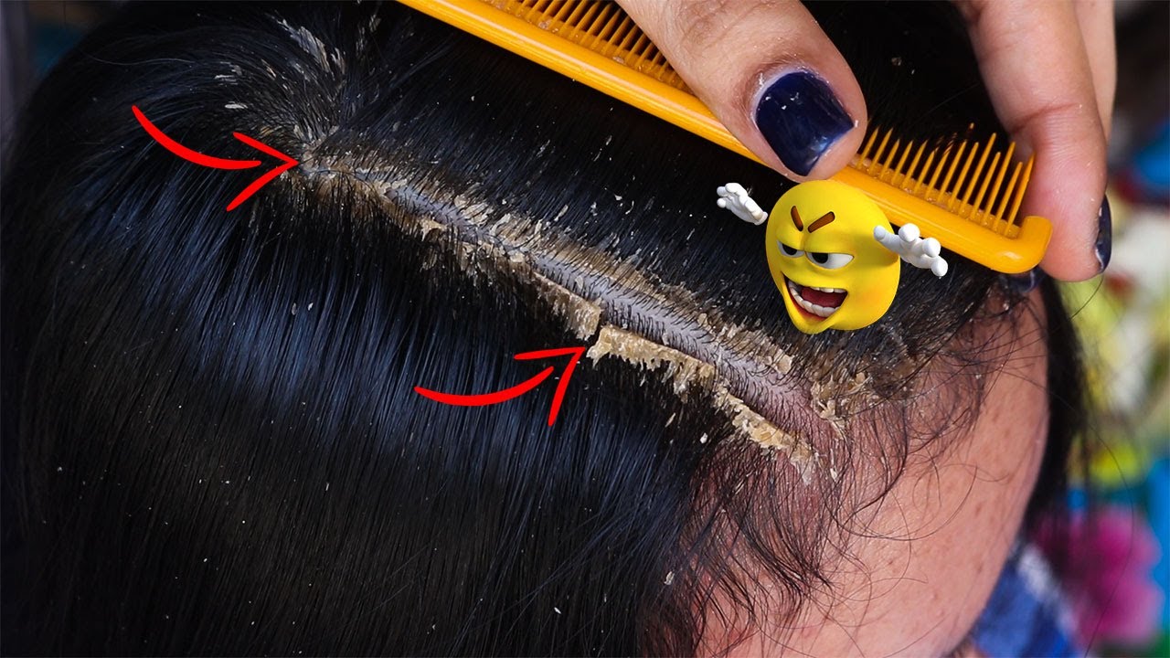 Dandruff And Picking Worm On Biggest #158 - YouTube