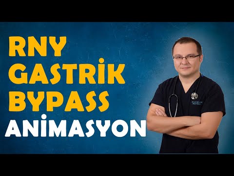 RNY Gastrik Bypass animasyon - Op. Dr. Fakı AKIN