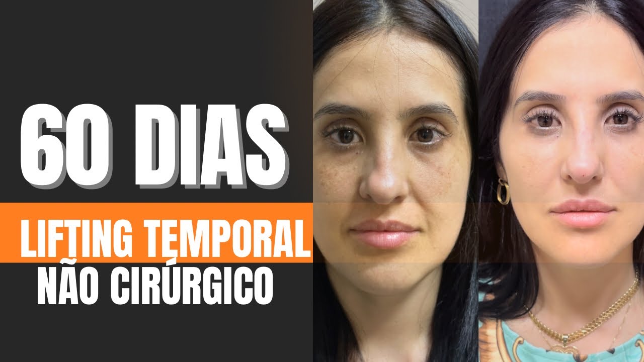 Lifting Temporal não Cirúrgico após 60 dias. Acompanhe o ...