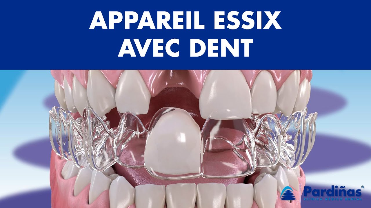 Appareil ESSIX avec dent - Une solution temporaire pour les DENTS ...