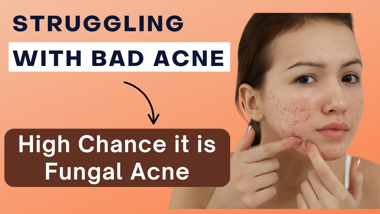 Fungal Acne 101 - How to Prevent, Spot & Treat - YouTube
