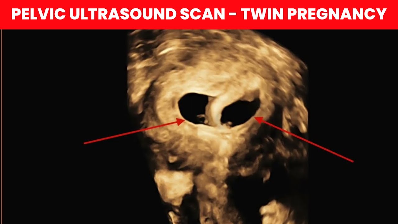 Pelvic Ultrasound Scan - Twin Pregnancy | Dr Kunal Rathod - YouTube