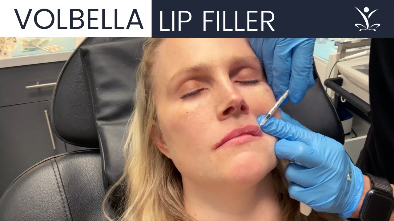Long-Lasting Volbella Lip Filler - YouTube