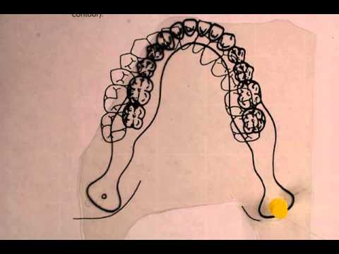 2mm immediate mandibular lateral translation - YouTube