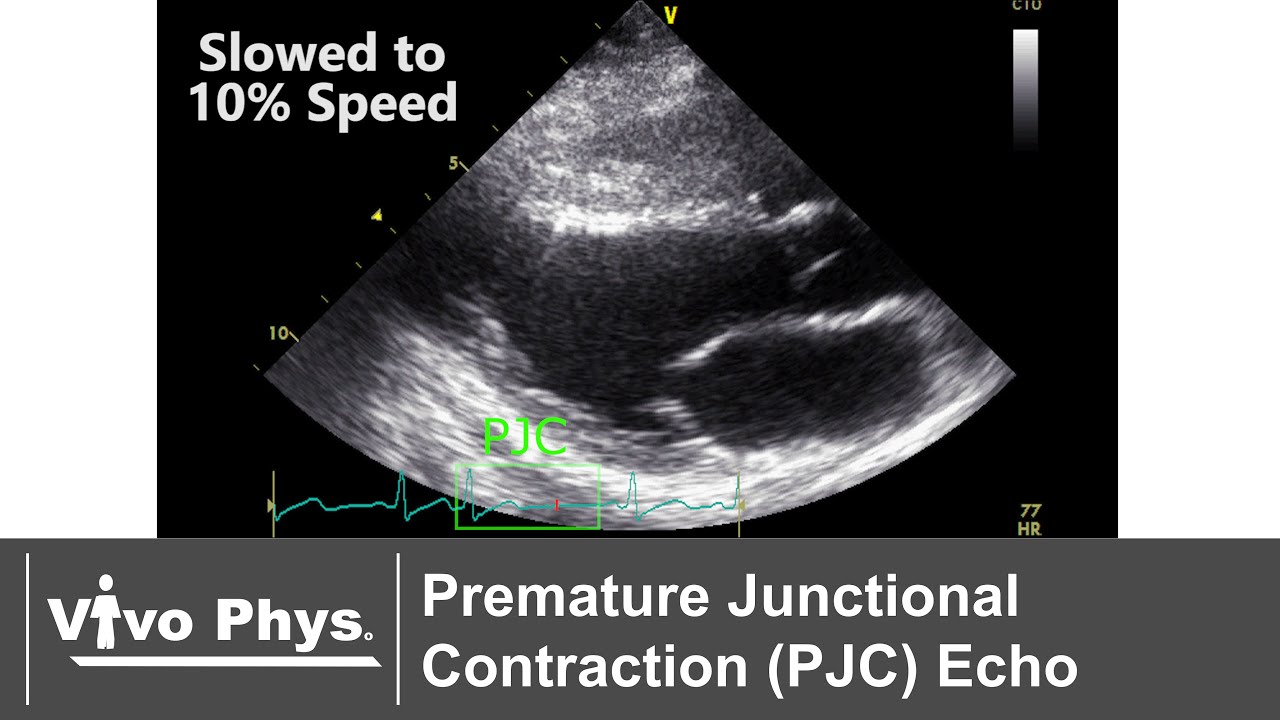 Premature Junctional Contraction (PJC) Echo Parasternal Long Axis View ...
