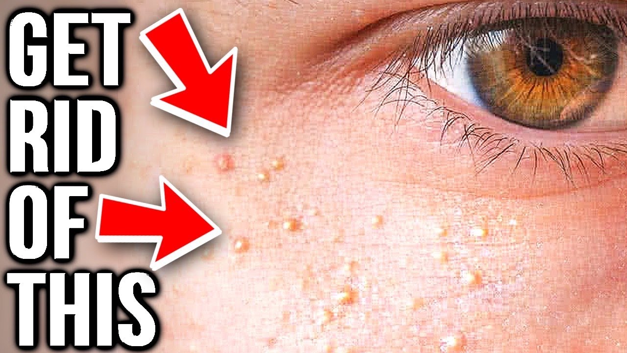 HOW TO GET RID OF MILIA (& Keep It From Coming Back!) - YouTube
