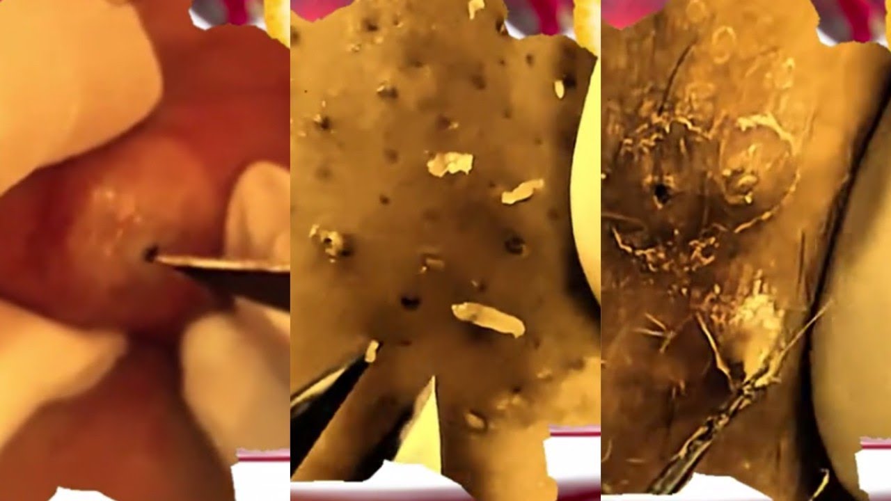 Satisfying Pimple Popping ASMR — Huge Zit & Blackhead Removal | 027 - YouTube