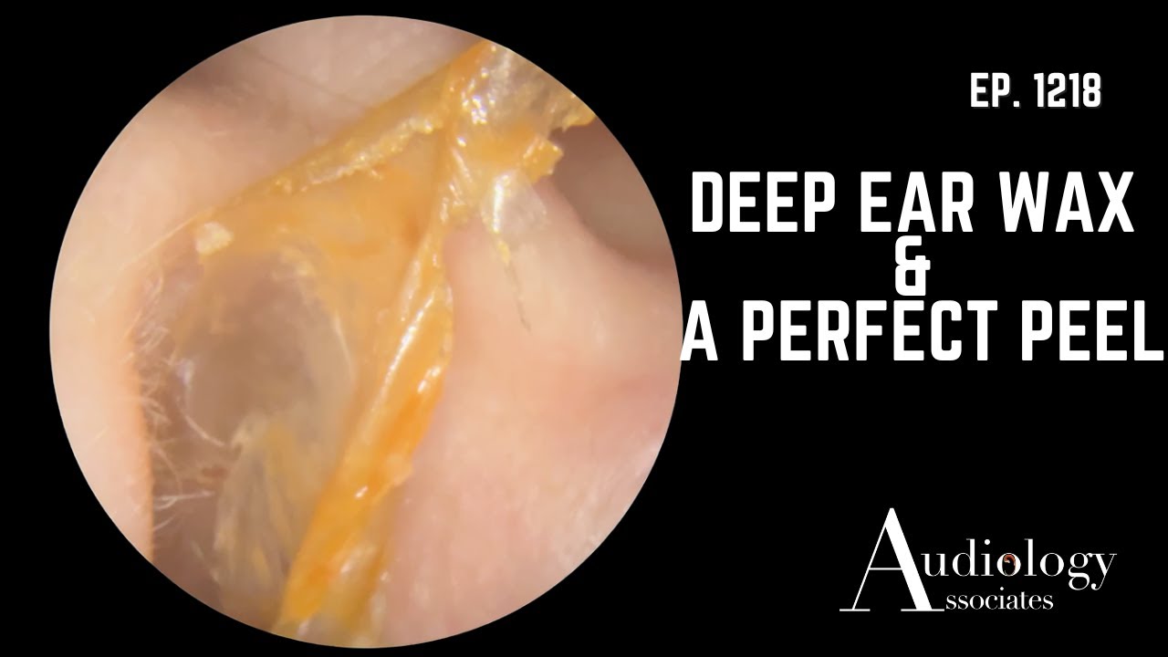 Satisfying Ear Wax Plugs & Eardrum Skin Peel Removal (Explained by ...
