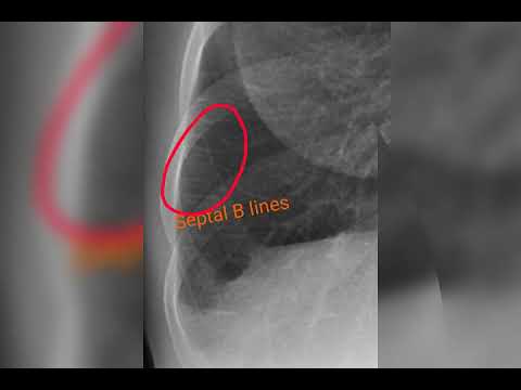 Kerley B lines - YouTube