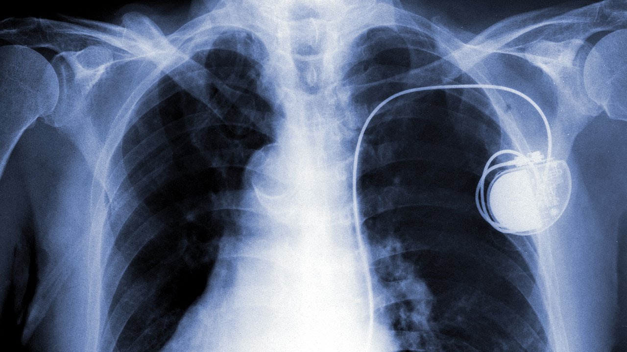 Human Physiology - Pacemaker Activity - YouTube