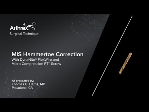 MIS Hammertoe Correction With DynaNite® FlexWire and Micro Compression ...