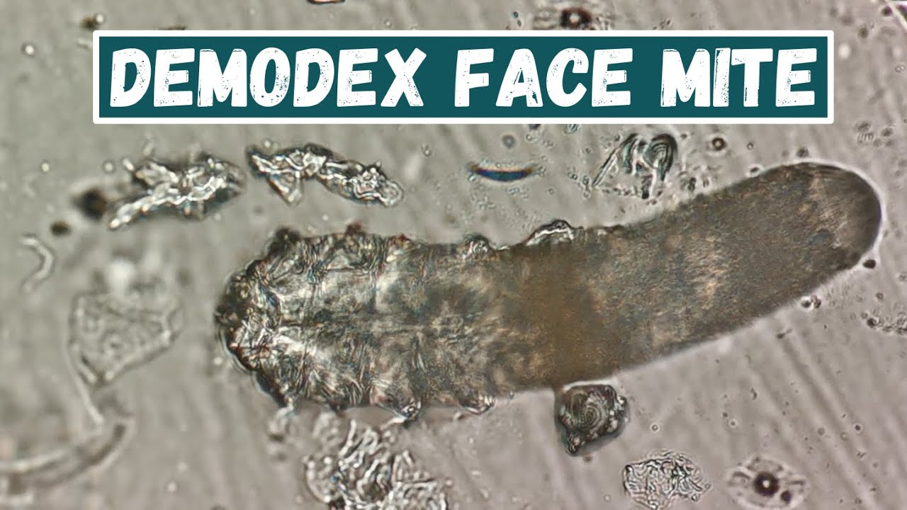 Demodex FACE MITE - YouTube