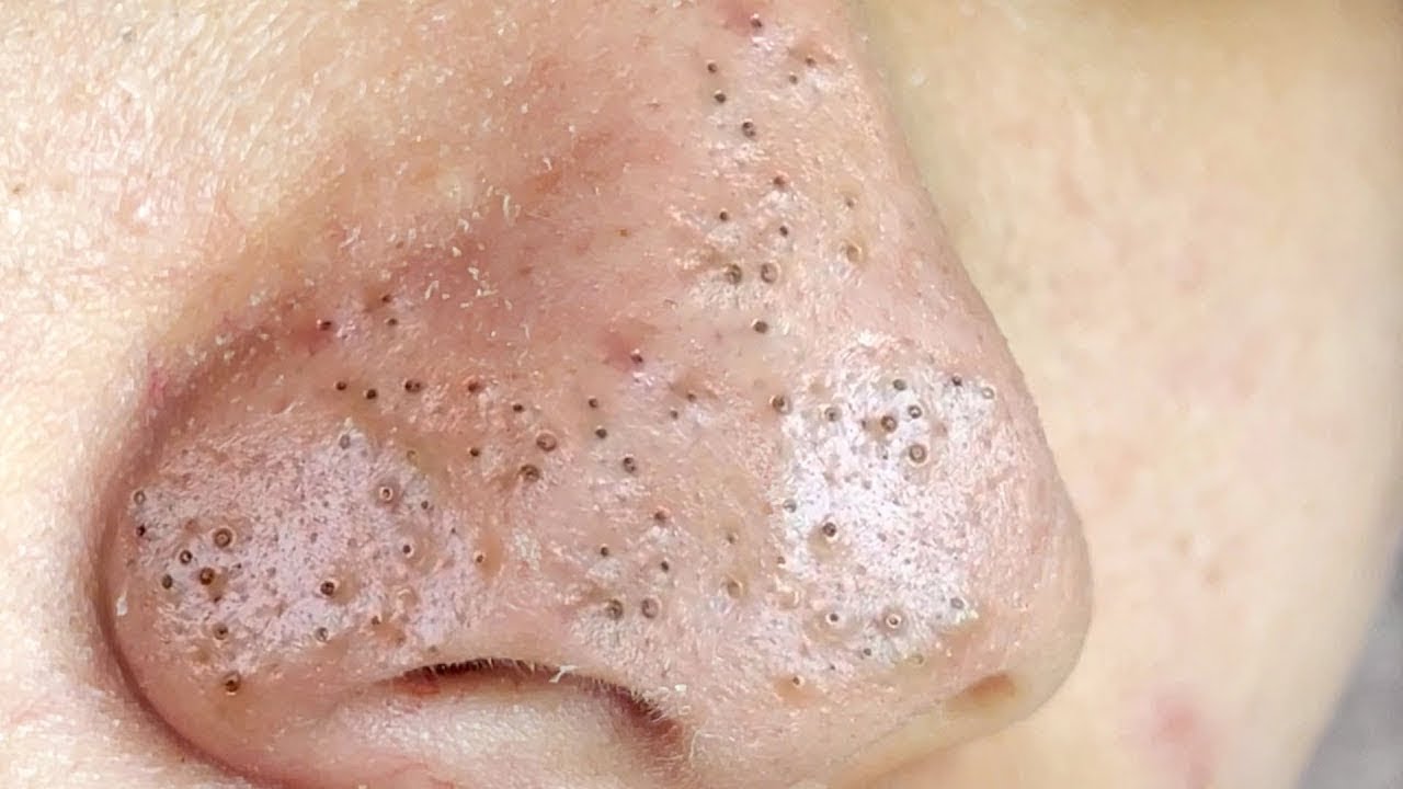 Big Cystic Acne Blackheads Extraction Blackheads & Milia, Whiteheads ...