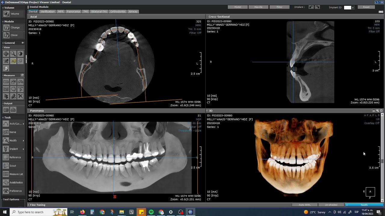 Pasos para ver ver tomografías en CDViewer - YouTube